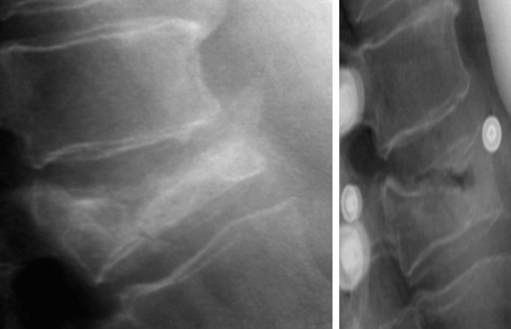 Fracture vertébrale thoraco-lombaire - Centre Orthopédique Santy