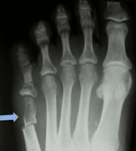 Quintus varus - Centre Orthopédique Santy